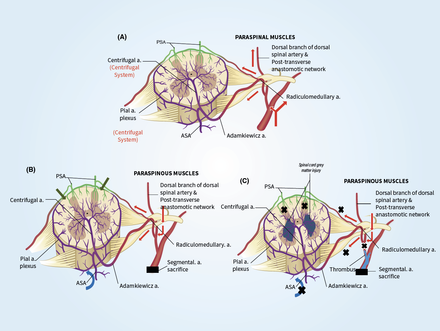 Dr. Hamdy Awad - Eliminating Paralysis After Aortic Aneurysm Surgery ...